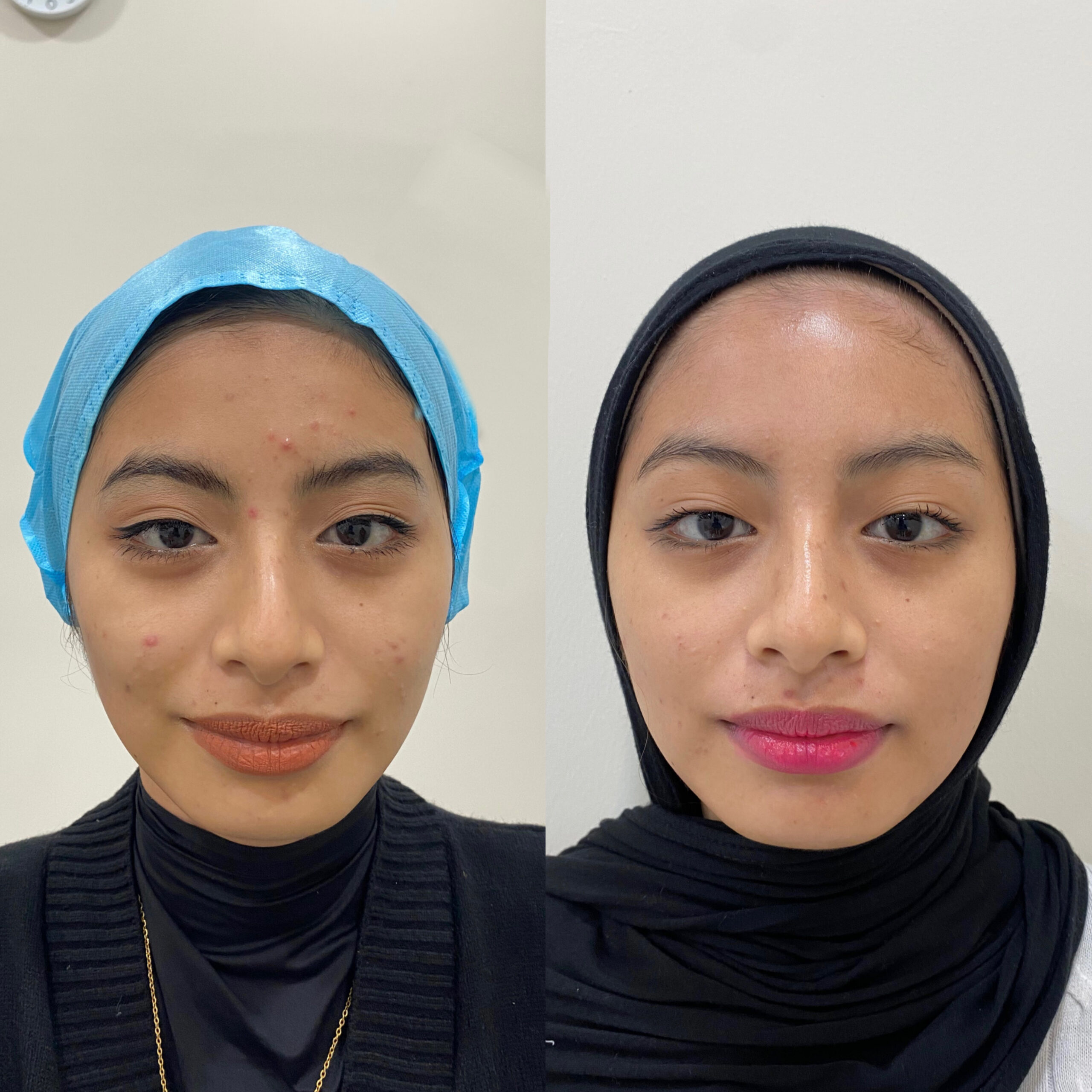 Skin Rejuvenation Bella Clinic skin-rejuvenation-bella-clinic